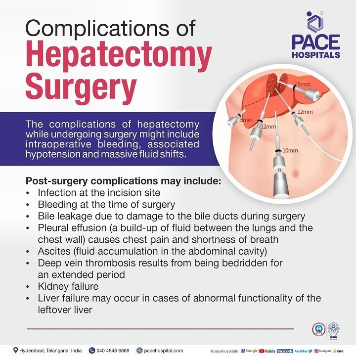 Hepatectomy Surgery in Hyderabad - Types, Procedure Indications & Cost