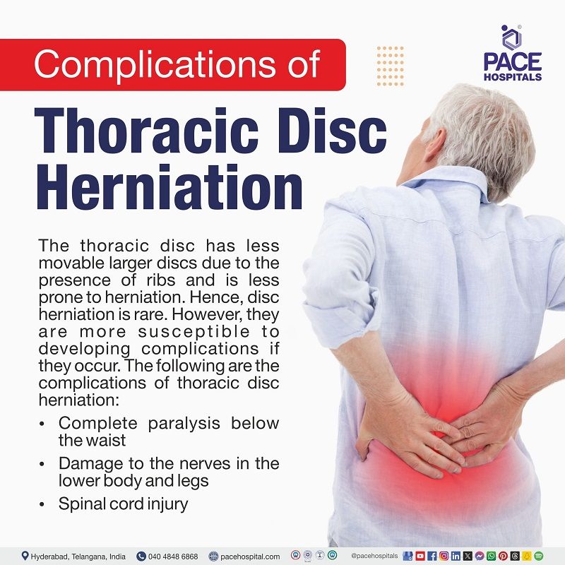 Thoracic Disc Herniation - Symptoms, Causes and Preventions