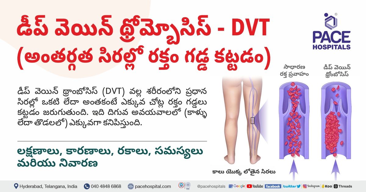 డీప్ వెయిన్ థ్రాంబోసిస్ -లక్షణాలు, కారణాలు, రోగ నిర్ధారణ, చికిత్స