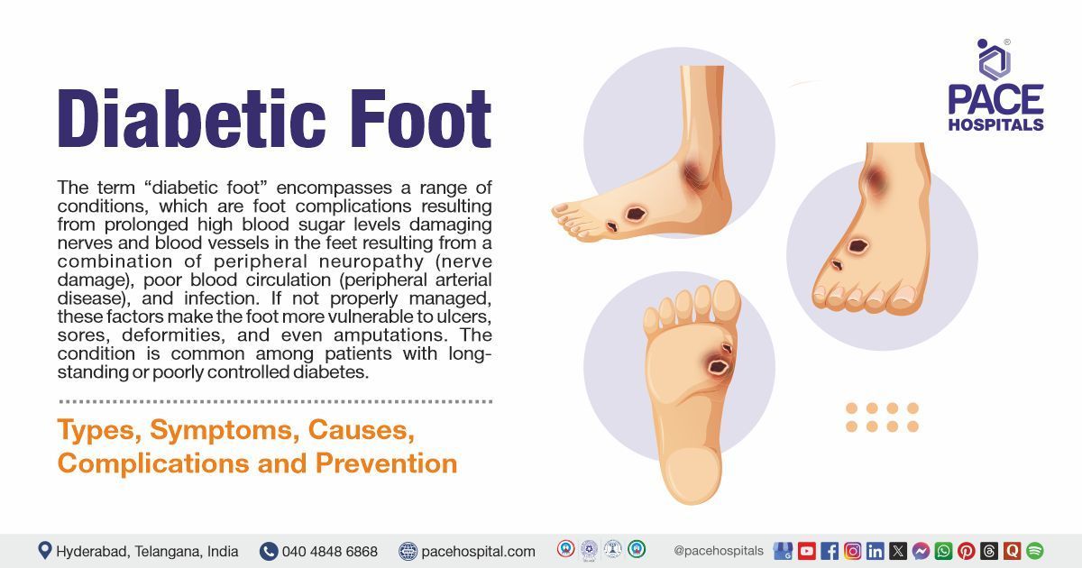 Diabetic Foot: Symptoms, Causes, Complications & Treatment