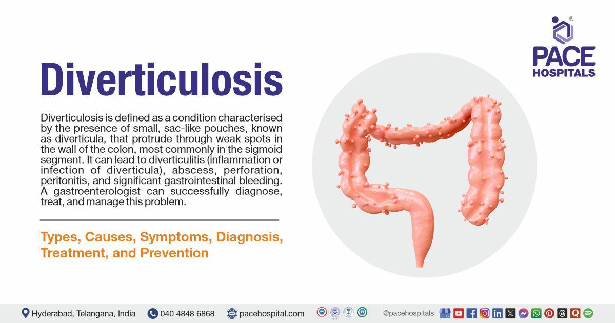 false diverticulum layers