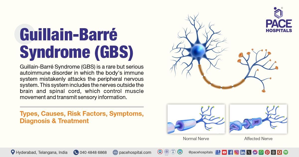 Guillain-Barré syndrome: Types, Symptoms, Causes & Treatment