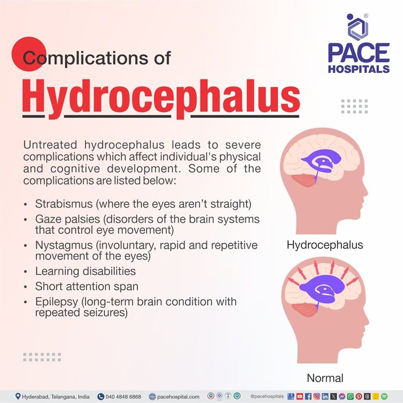 Hydrocephalus - Causes, Types, Symptoms, Treatment & Complication