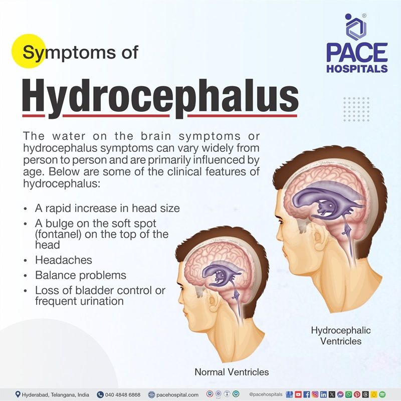 Hydrocephalus - Causes, Types, Symptoms, Treatment & Complication