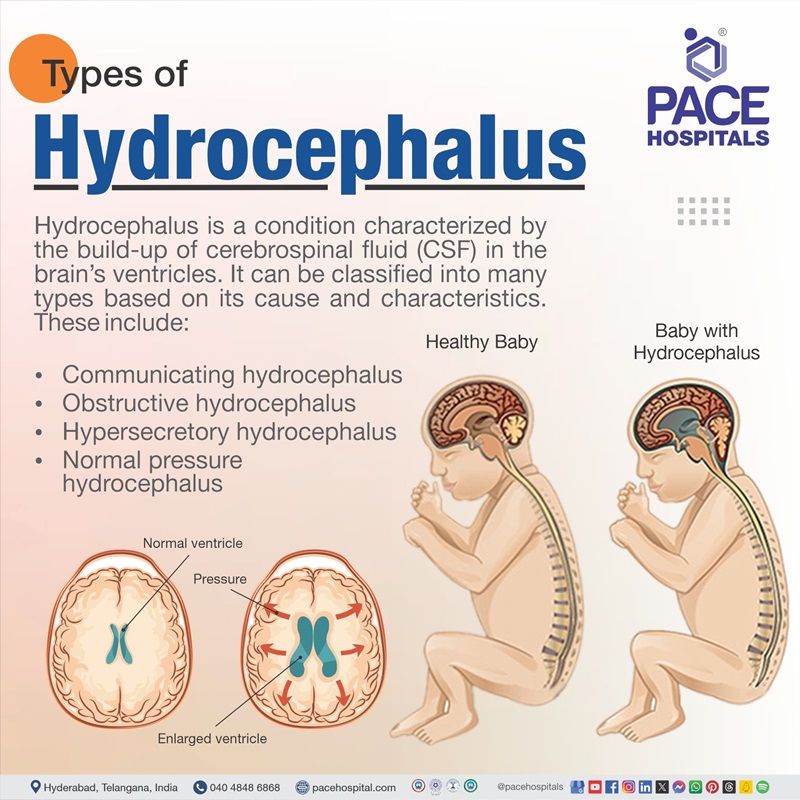 Hydrocephalus - Causes, Types, Symptoms, Treatment & Complication