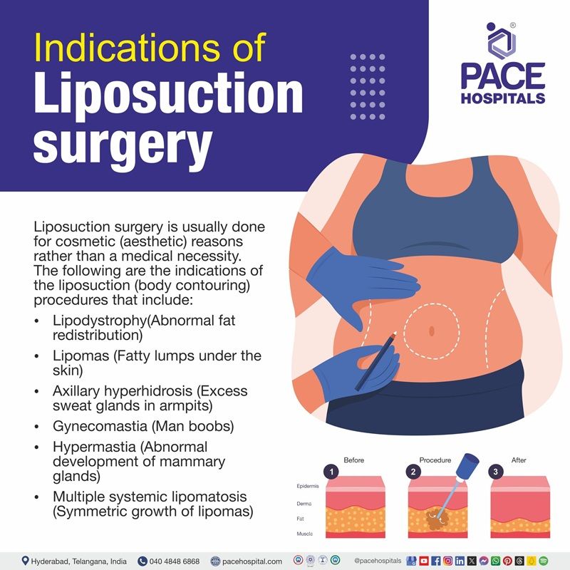 Best Liposuction Surgery in Hyderabad | Cost & Benefits