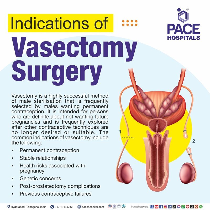 Best Vasectomy Surgery in Hyderabad, India | Male Sterilization