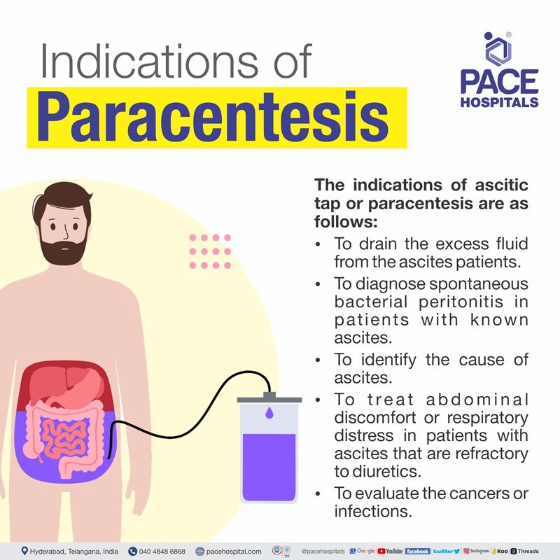 Paracentesis (Ascites Tapping) in Hyderabad, India | Indication & Cost