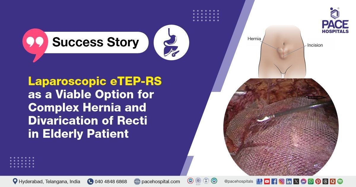 Successful eTEP-RS Procedure for Incisional Hernia & Recti Repair