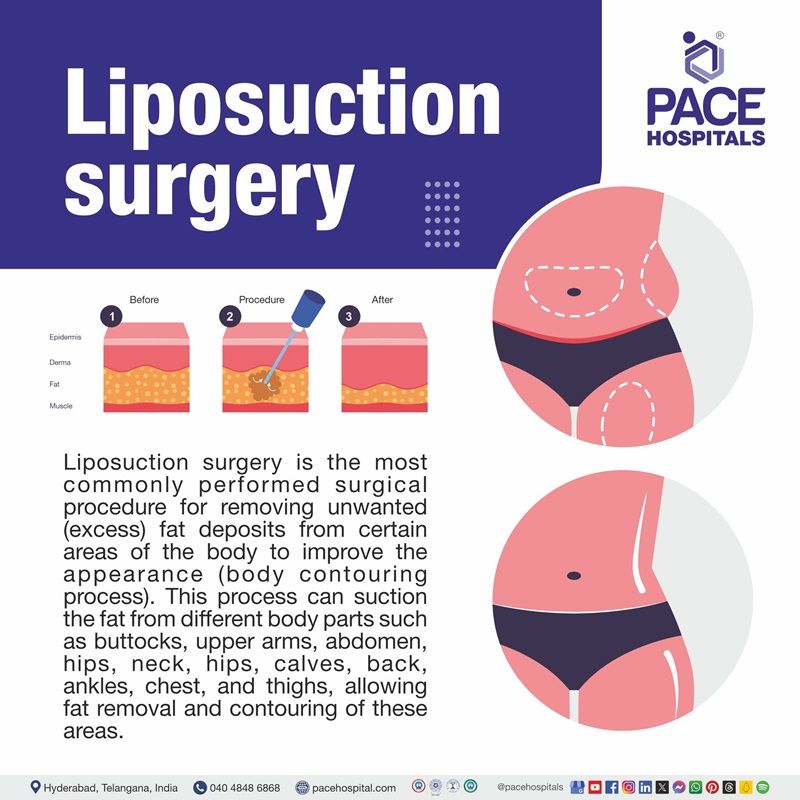 Best Liposuction Surgery in Hyderabad | Cost & Benefits