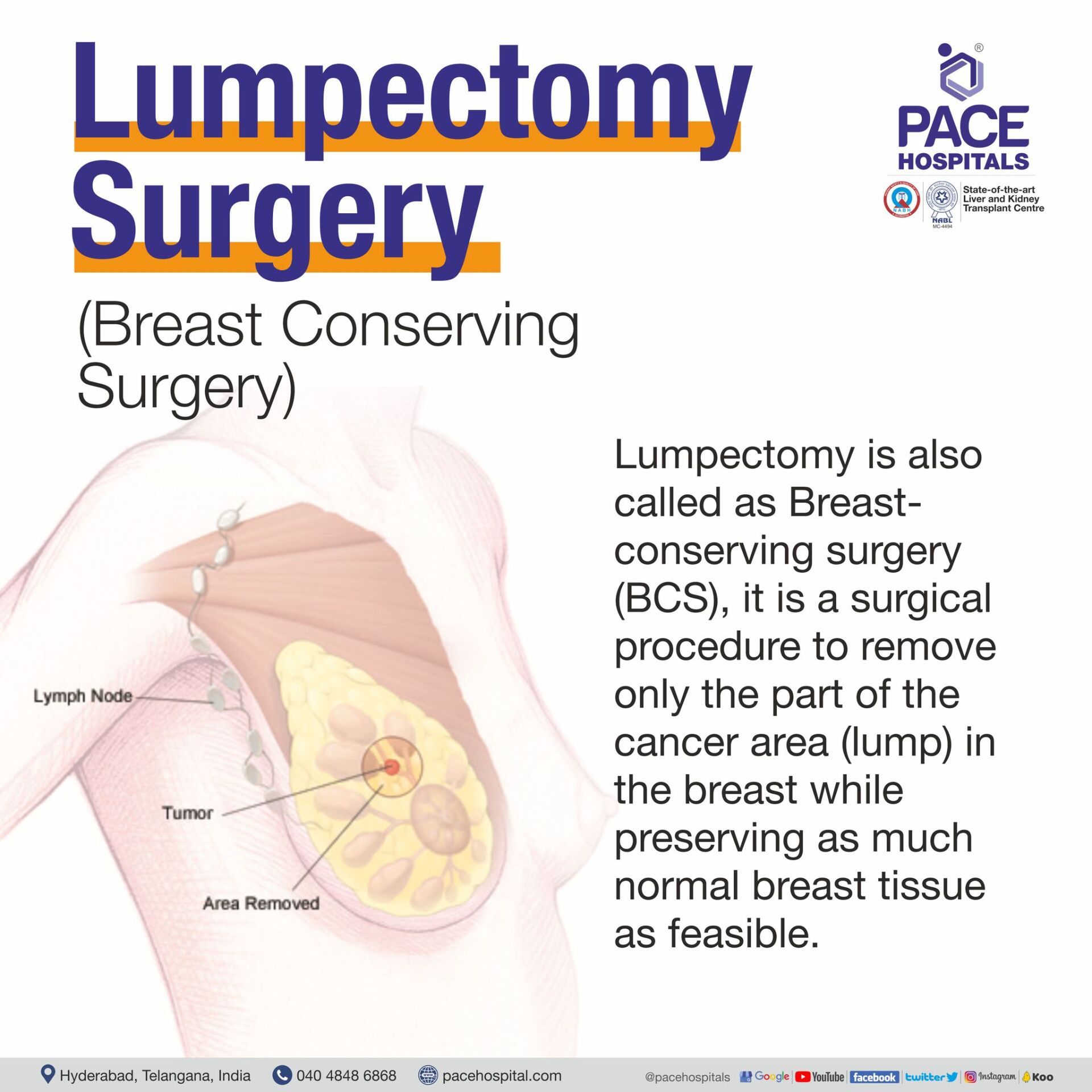 Lumpectomy - Breast Conserving Surgery in Hyderabad | Recovery & Cost