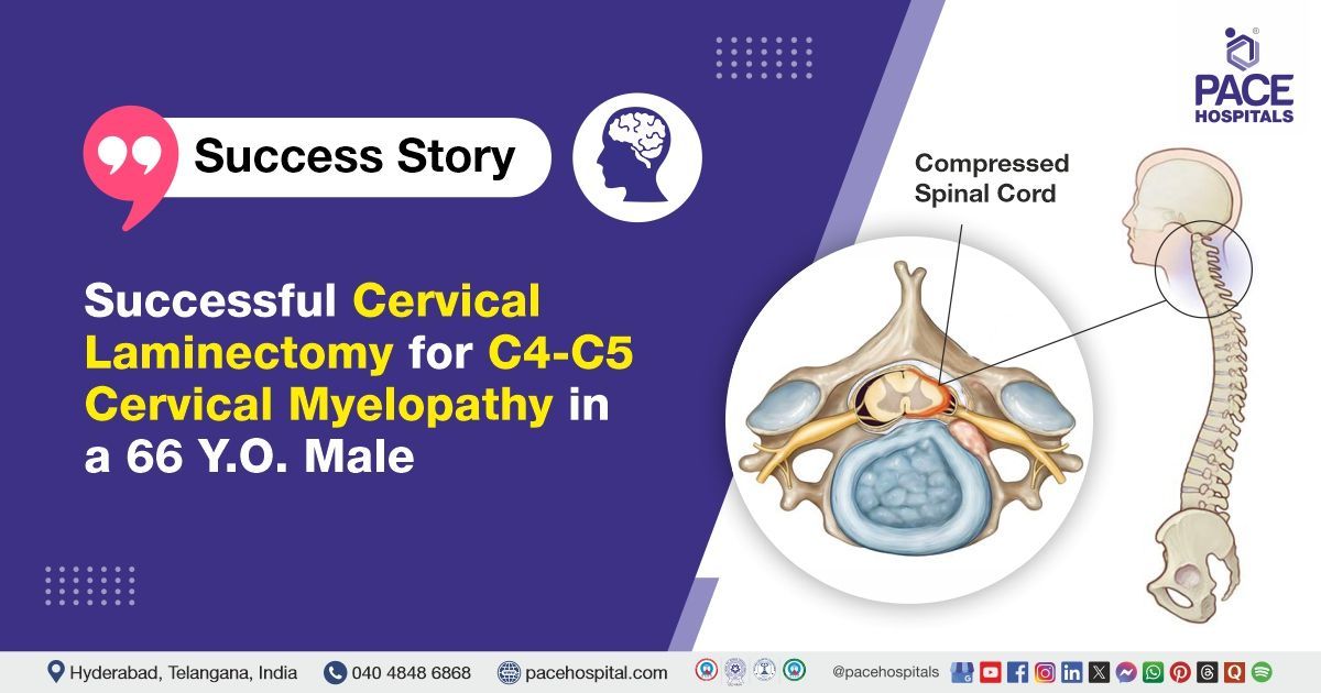 Successful Cervical Laminectomy for C4-C5 Cervical Myelopathy