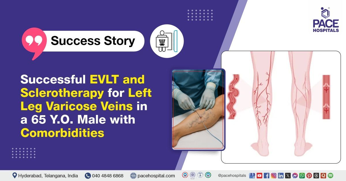 Left Leg Varicose Veins Treatment with EVLT & Sclerotherapy