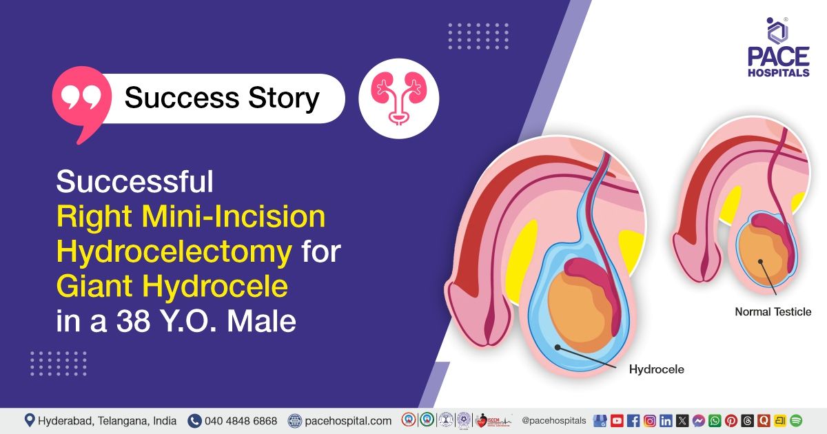 Right Hydrocelectomy Surgery for Giant Hydrocele in 38 Y.O. Male