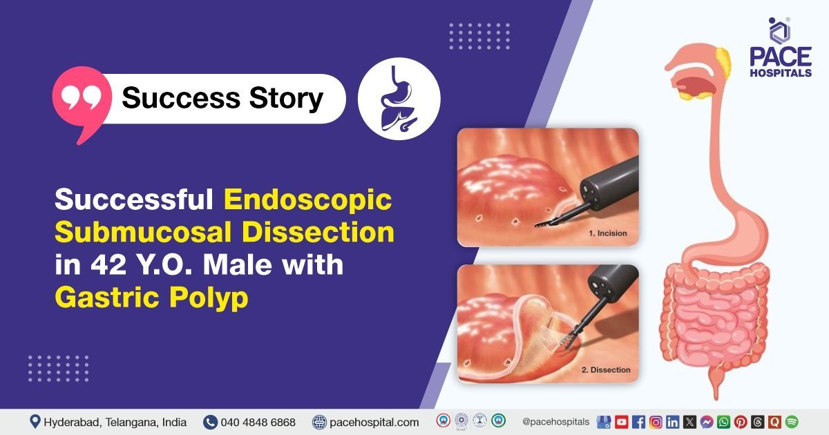 Gastric Polyp Treated with Endoscopic Submucosal Dissection
