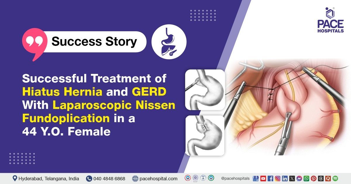 GERD & Hiatus Hernia Treated with Lap. Nissen Fundoplication