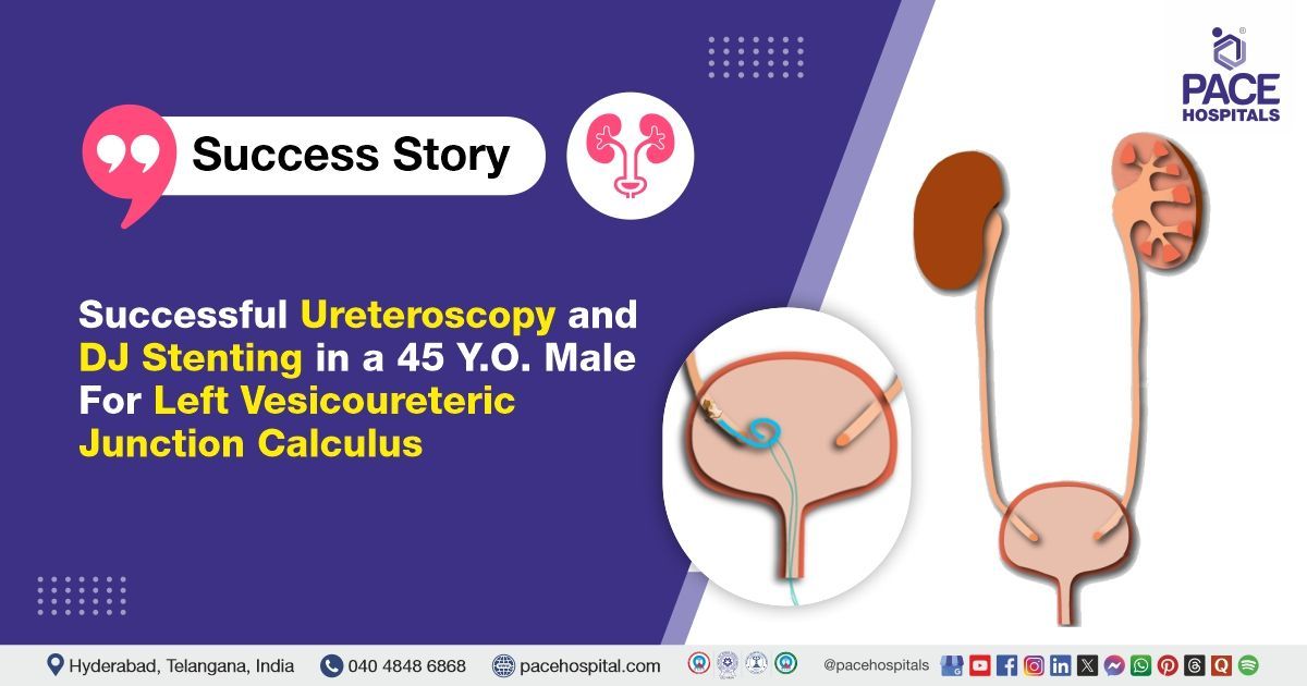 Left VUJ Calculus treated with Ureteroscopy and DJ Stenting