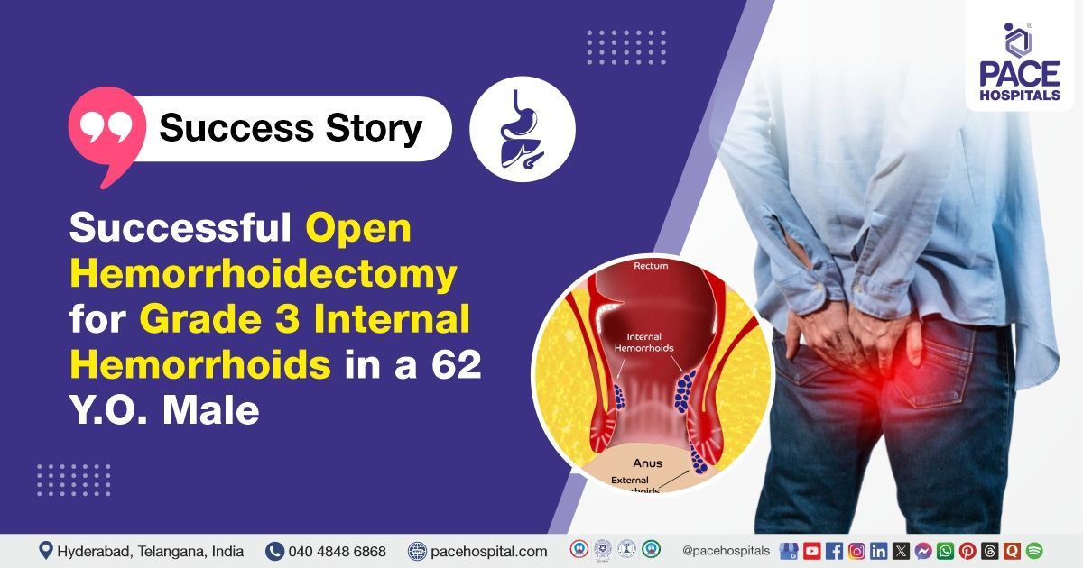 Grade 3 Internal Hemorrhoids treated with Open Hemorrhoidectomy
