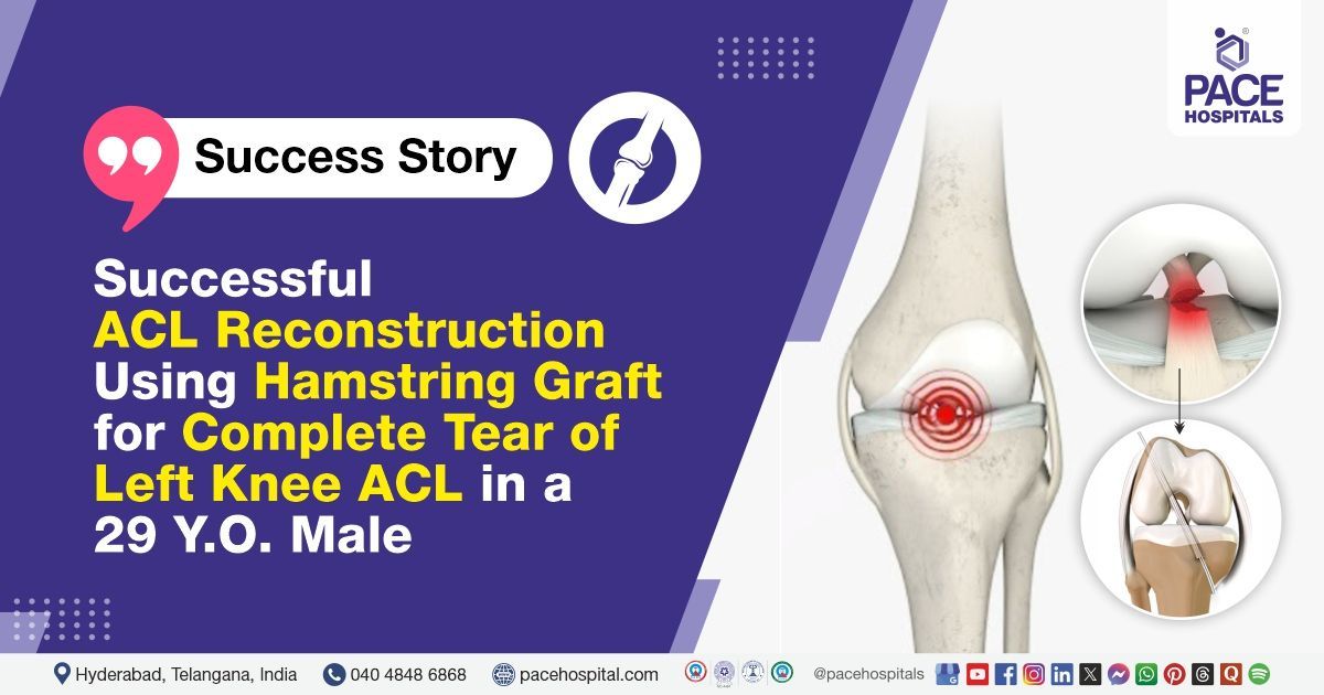 ACL Reconstruction with Hamstring Graft for Left Knee ACL Tear