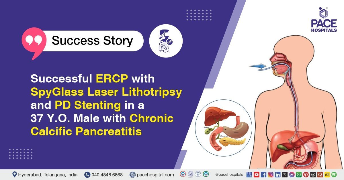 ERCP with SpyGlass Lithotripsy for Chronic Calcific Pancreatitis
