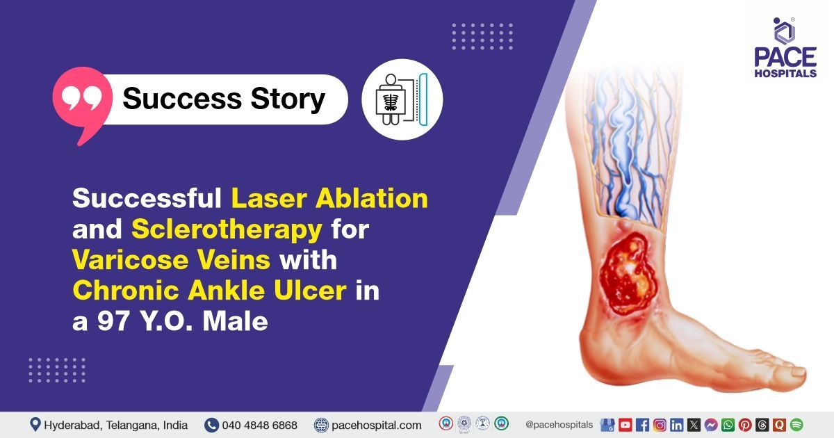 Laser Ablation & Sclerotherapy for Varicose Veins with Ulcer
