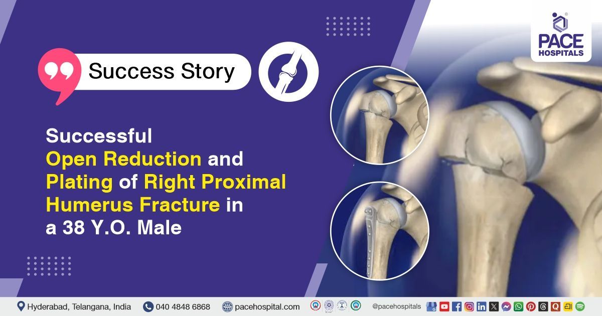 Right Humerus Fracture treated with Open Reduction and Plating