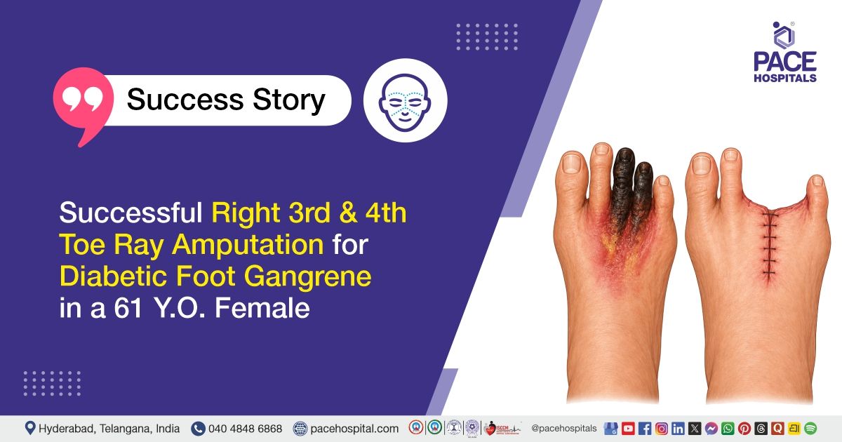 Toe Ray Amputation for Diabetic Foot Cellulitis with Gangrene