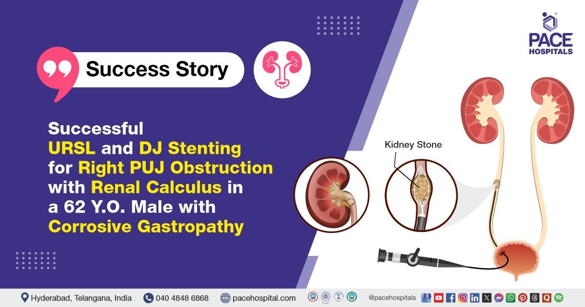 URSL & DJ Stenting for PUJ Obstruction with Renal Stone