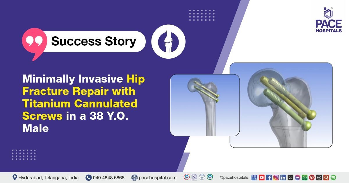 Hip Fracture Treatment with Cannulated Screw Fixation in 38 -Y-O