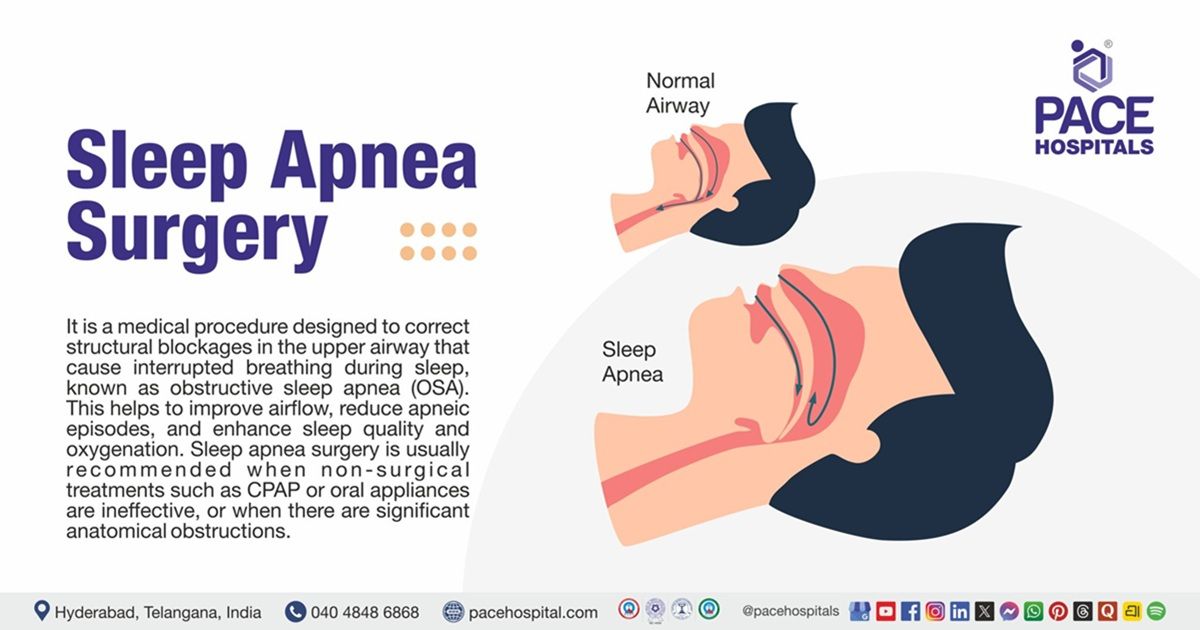 Obstructive Sleep Apnea Surgery in Hyderabad | Cost & Benefits