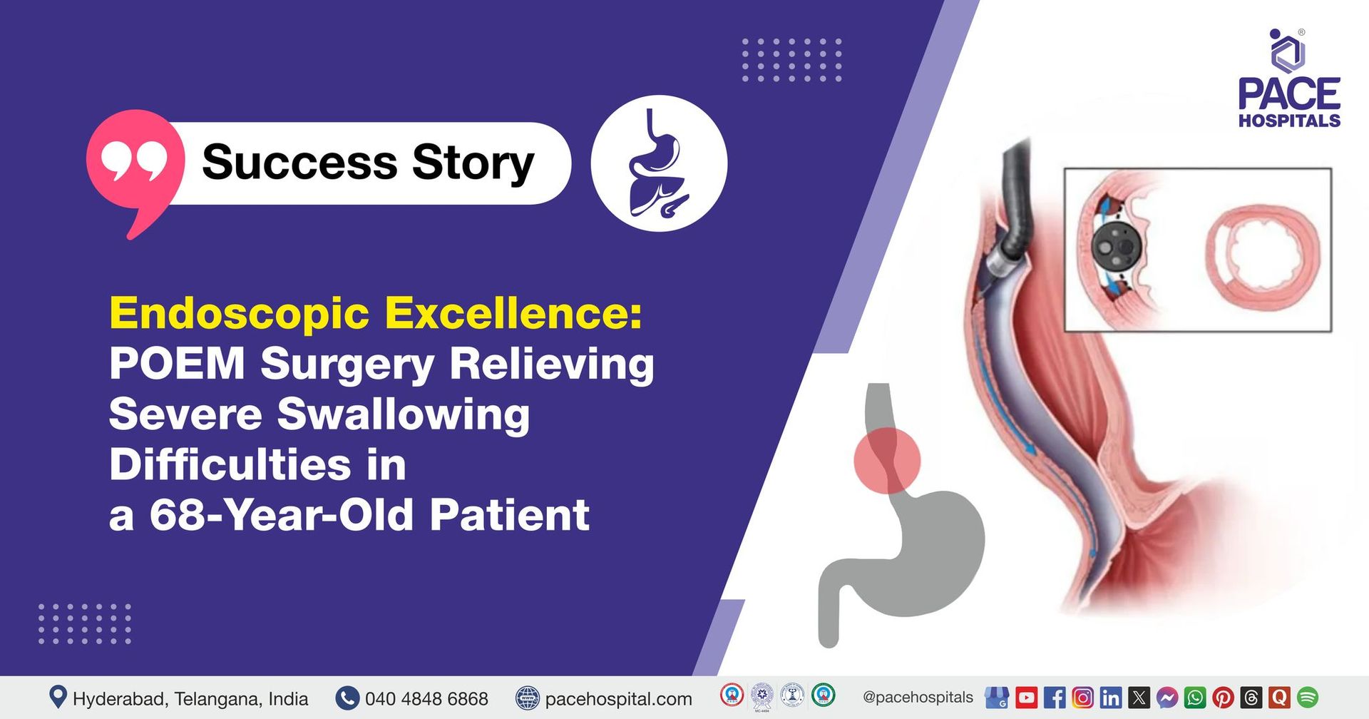 Endoscopic POEM Surgery for Achalasia Cardia Treatment in India