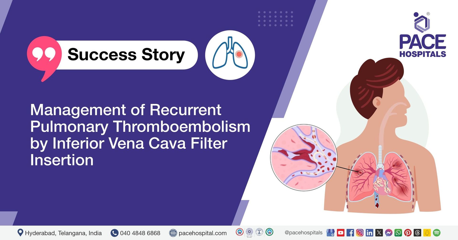 IVC Filter Insertion to Treat Recurrent Pulmonary Thromboembolism
