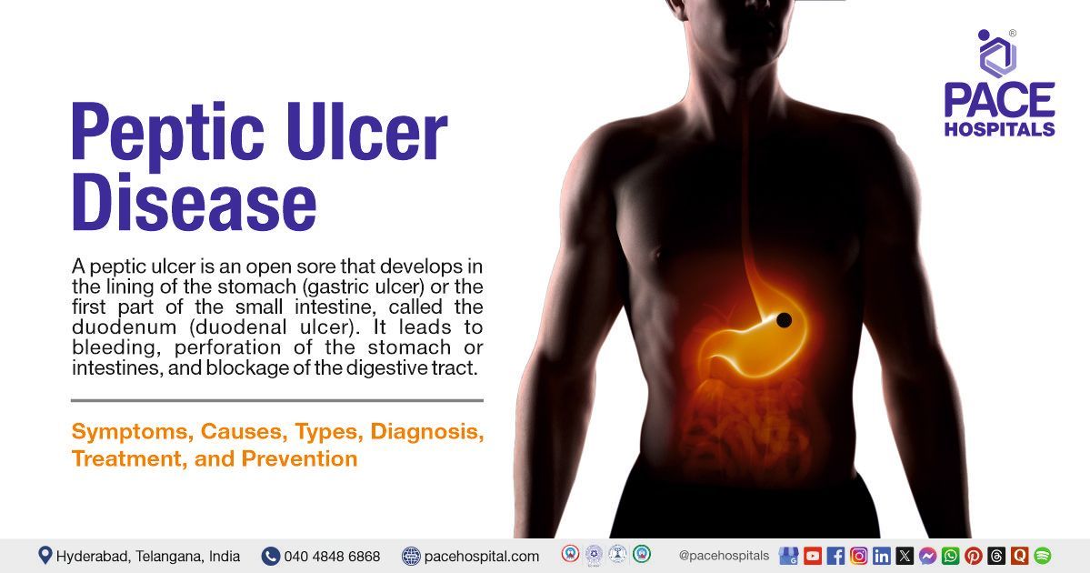 Peptic Ulcer - Types, Symptoms, Causes, Diagnosis & Treatment