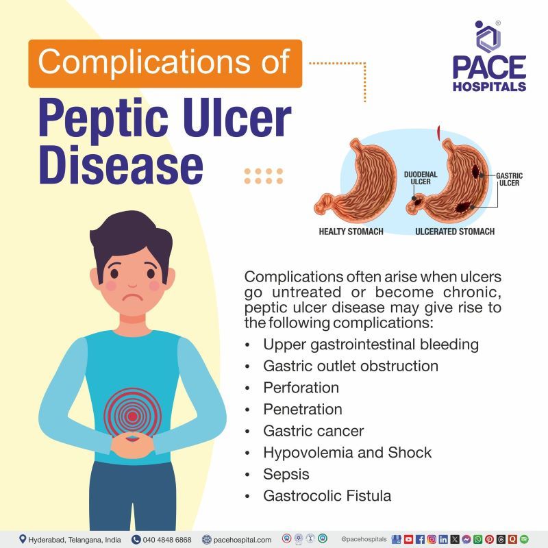 Peptic Ulcer - Types, Symptoms, Causes, Diagnosis & Treatment