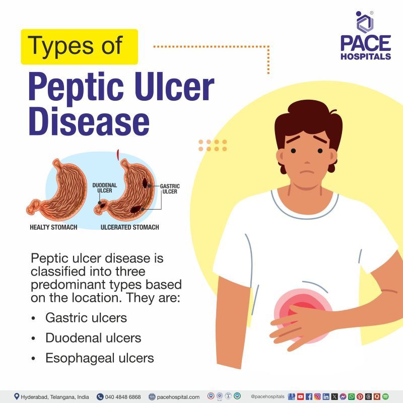 Peptic Ulcer - Types, Symptoms, Causes, Diagnosis & Treatment