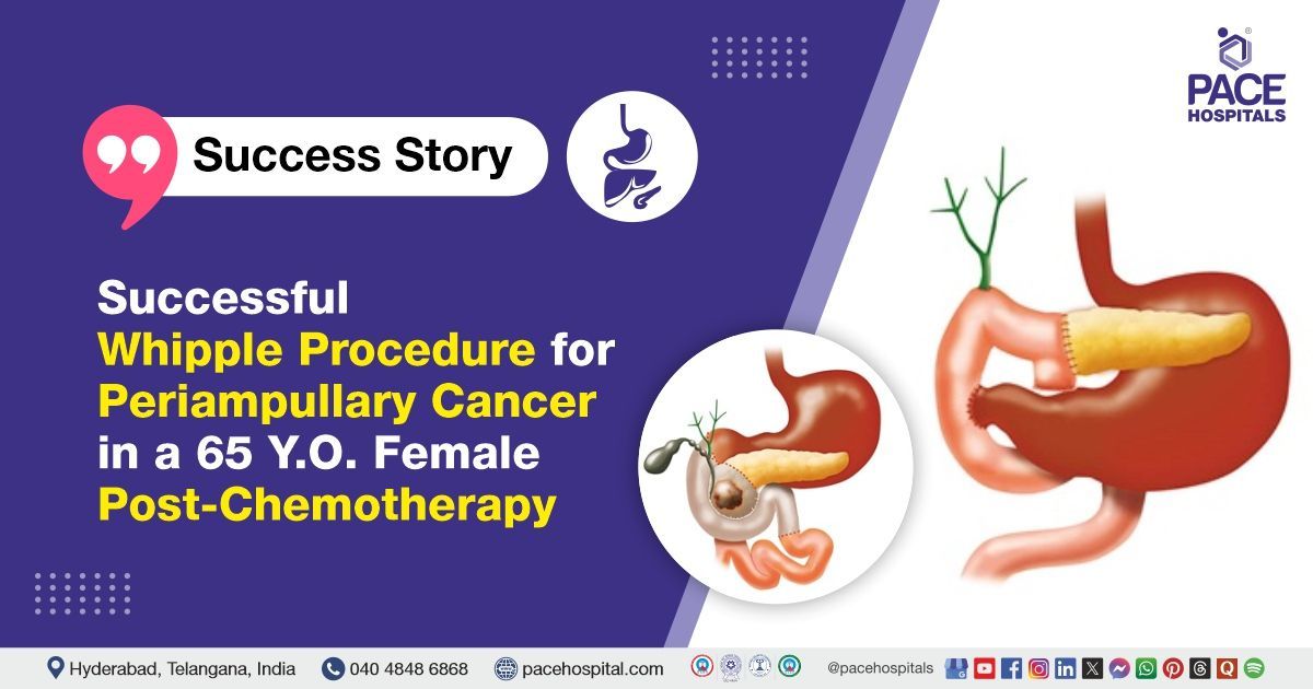Periampullary Cancer Treated Successfully with Whipple Procedure