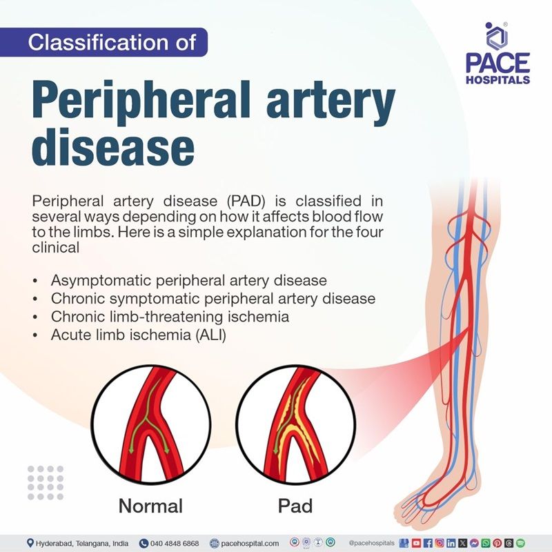 Peripheral Artery Disease (PAD) – Symptoms, Causes and Treatment