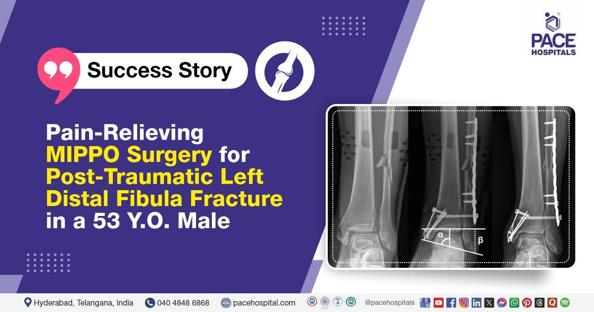Left Distal Fibula Fracture Treated with MIPPO Procedure