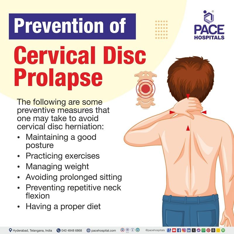 Cervical disc prolapse - Symptoms, Causes and Treatment