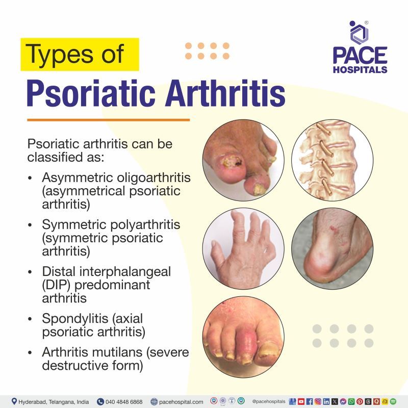 Psoriatic Arthritis: Symptoms, Causes, Treatment & Prevention