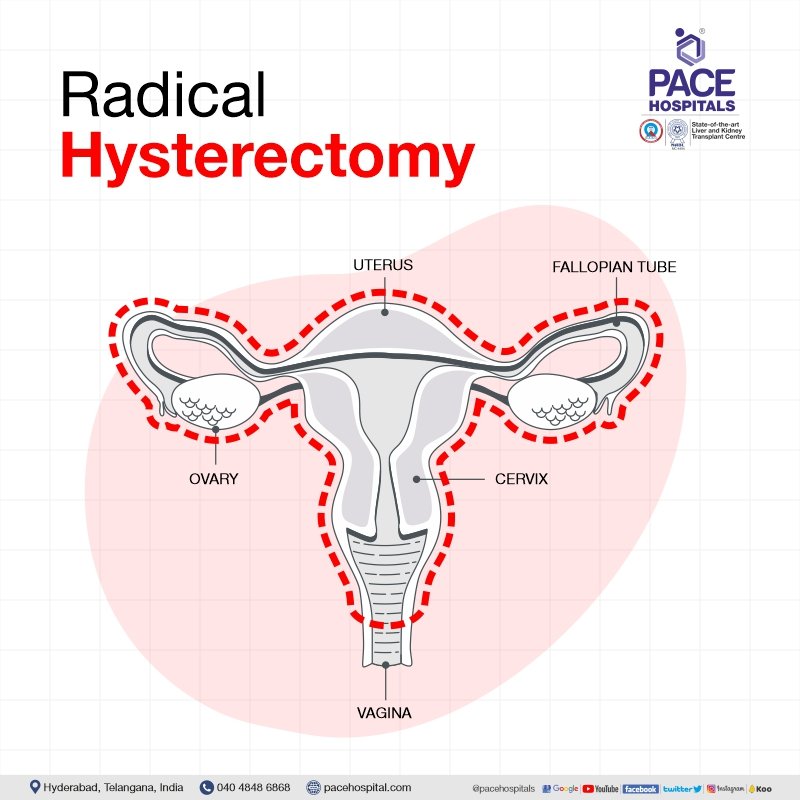 Hysterectomy Surgery in Hyderabad - Indications, Side effects & Cost