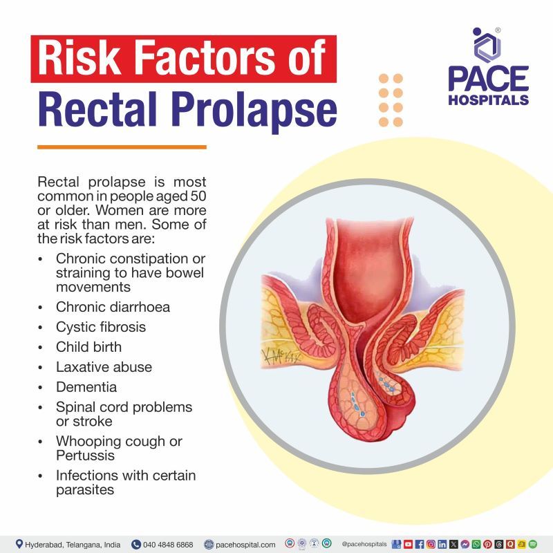 Rectal Prolapse: Symptoms, Causes, Diagnosis & Treatment
