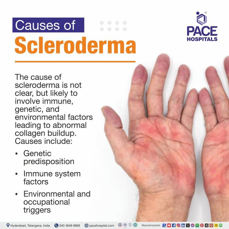 Scleroderma: Symptoms, Causes, Diagnosis & Treatment