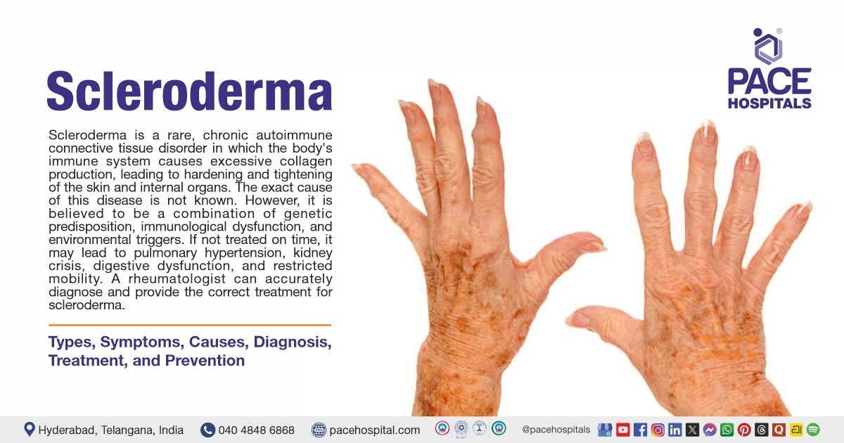 Scleroderma: Symptoms, Causes, Diagnosis & Treatment