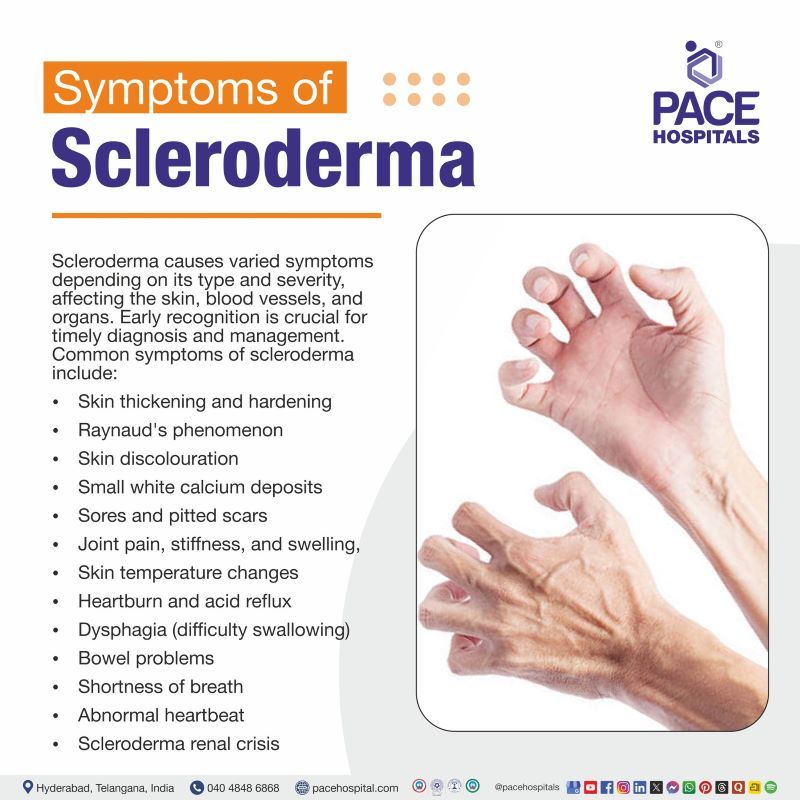 Scleroderma: Symptoms, Causes, Diagnosis & Treatment