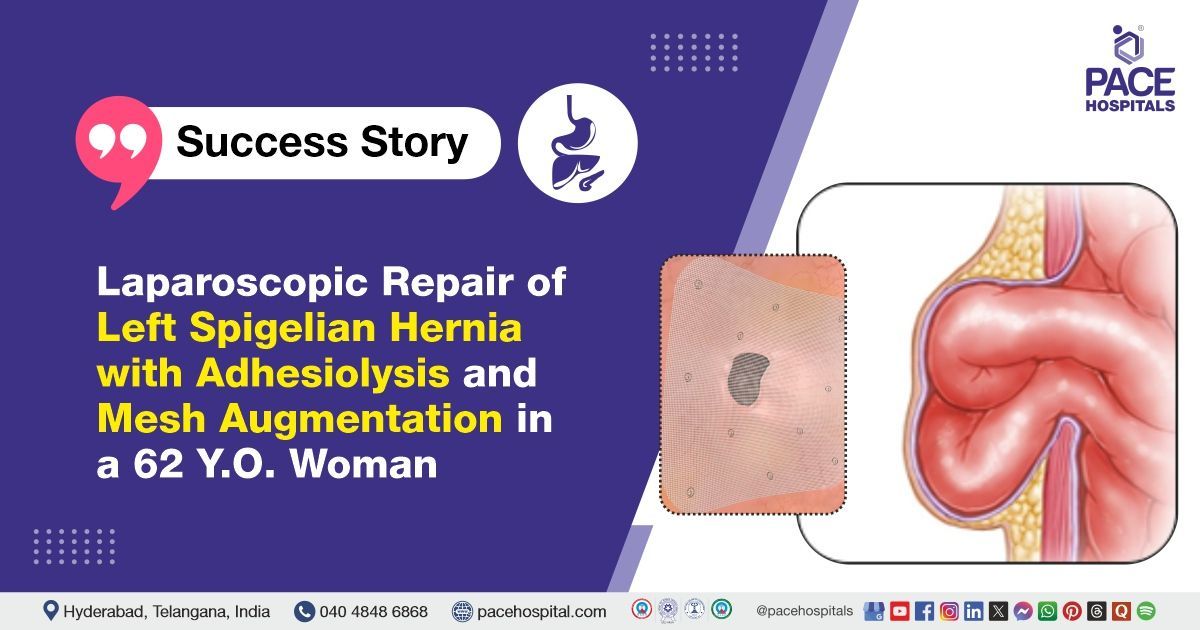 Spigelian Hernia Treated with Adhesiolysis & Mesh Augmentation