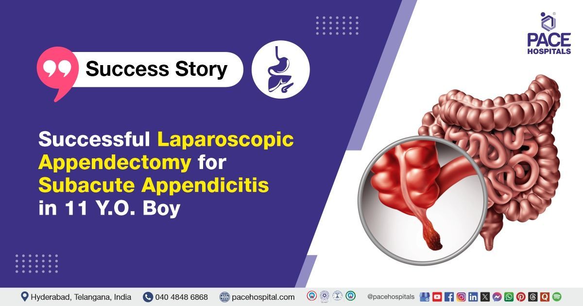 Subacute Appendicitis Treated with Laparoscopic Appendectomy