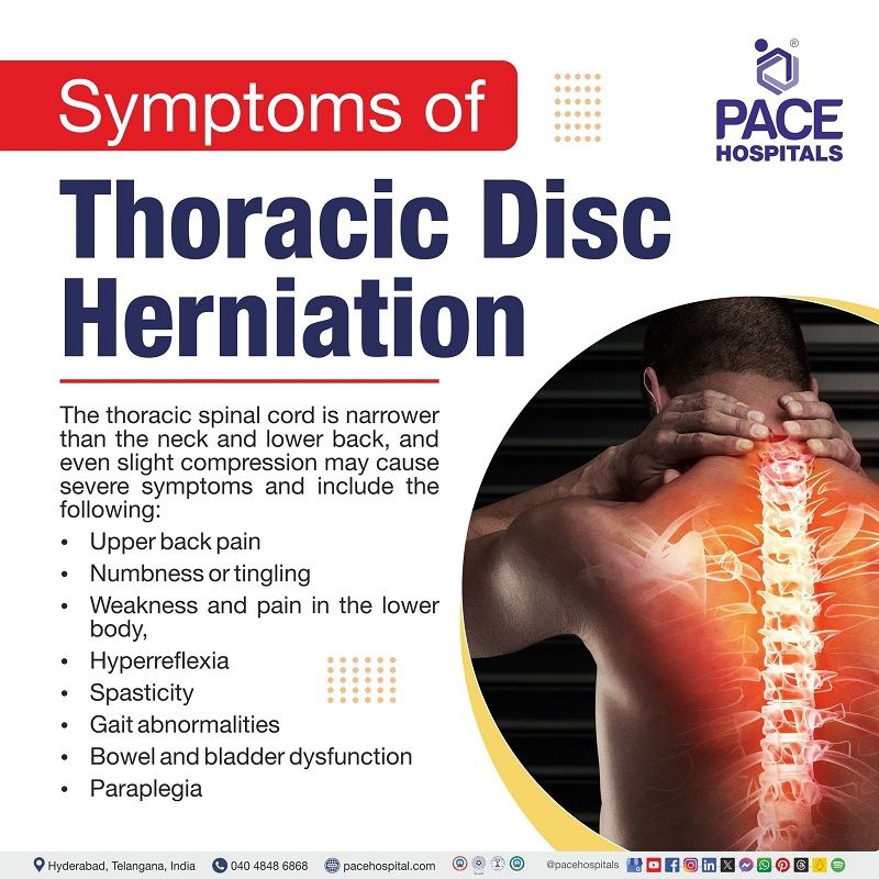 Thoracic Disc Herniation - Symptoms, Causes and Preventions