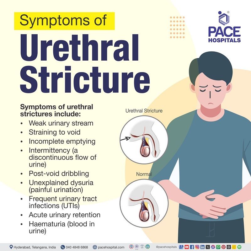 Urethral Stricture - Symptoms, Causes, Types and Treatment