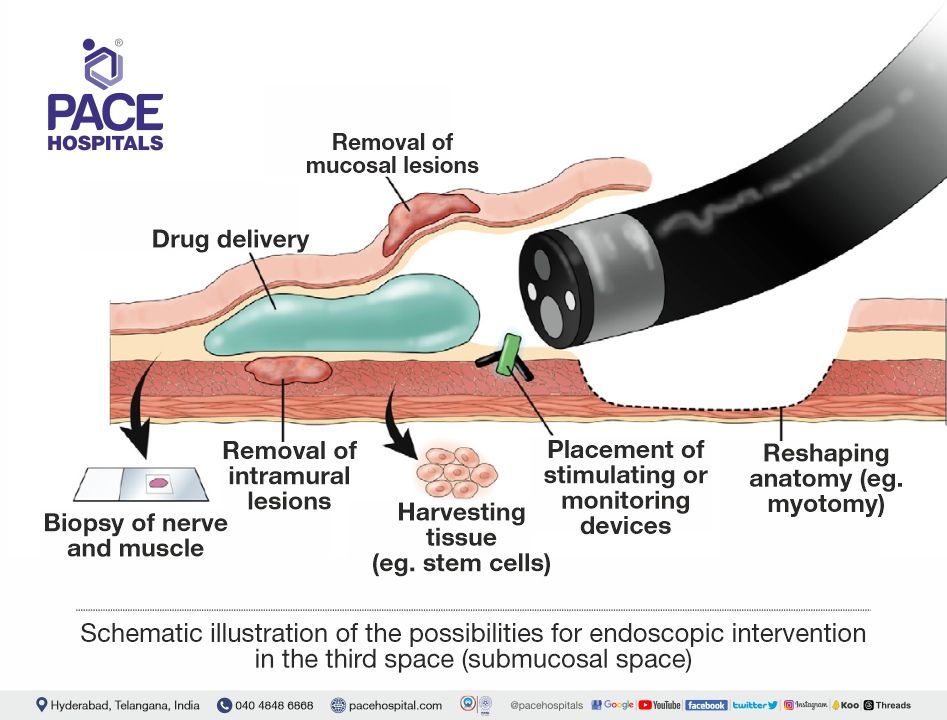 Third Space Endoscopy in Hyderabad, India - Indications & Techniques